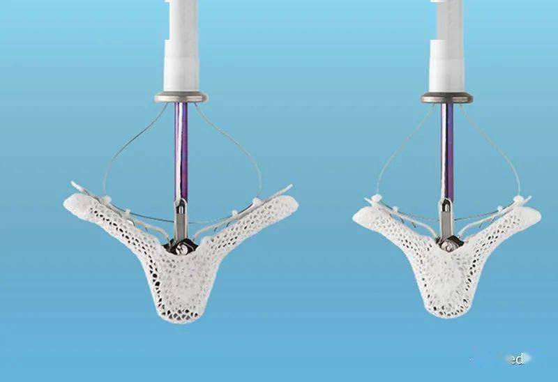 雅培：MitraClip G4获得CE批准_二尖瓣