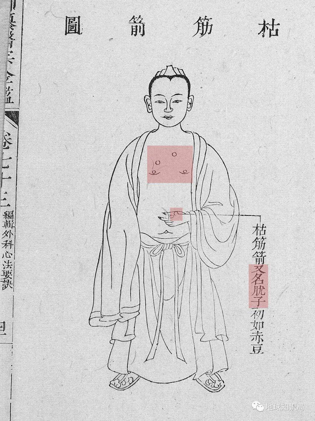 尖锐湿疣,不只是长菜花 地球知识局疾病生殖器蟾蜍