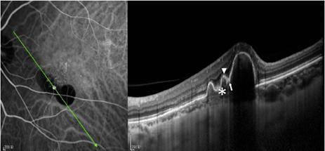 医讯‖我院眼科开展FFA与ICGA同步造影技术_病变