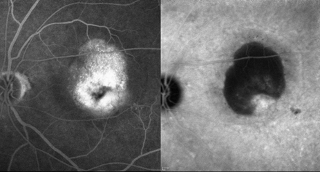 医讯‖我院眼科开展FFA与ICGA同步造影技术_病变