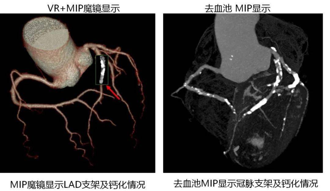 CT后处理技巧——MIP与VIP-搜狐大视野-搜狐新闻