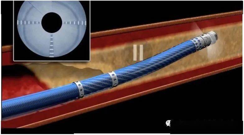 FDA批准Avinger医疗影像指导CTO传送系统_the