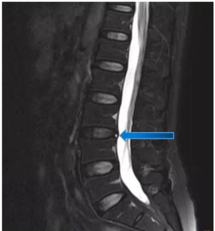 诊断小课堂：腰椎椎间盘高信号区（HIZ）_阿姨