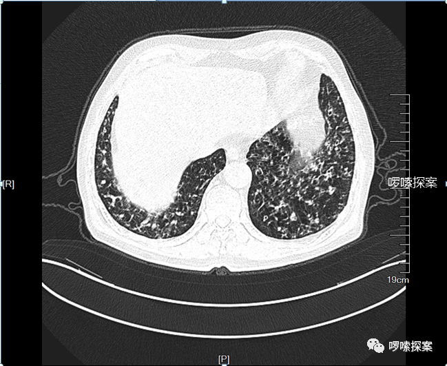 百闻不如一见，CT展示典型的DPB_双下