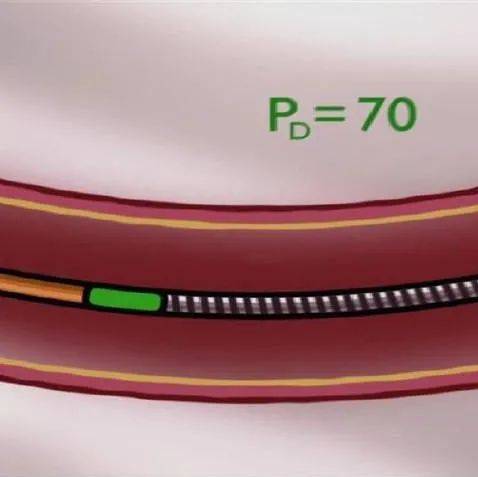 TCT2021丨FFR指导的PCI风险小且费用低_医疗