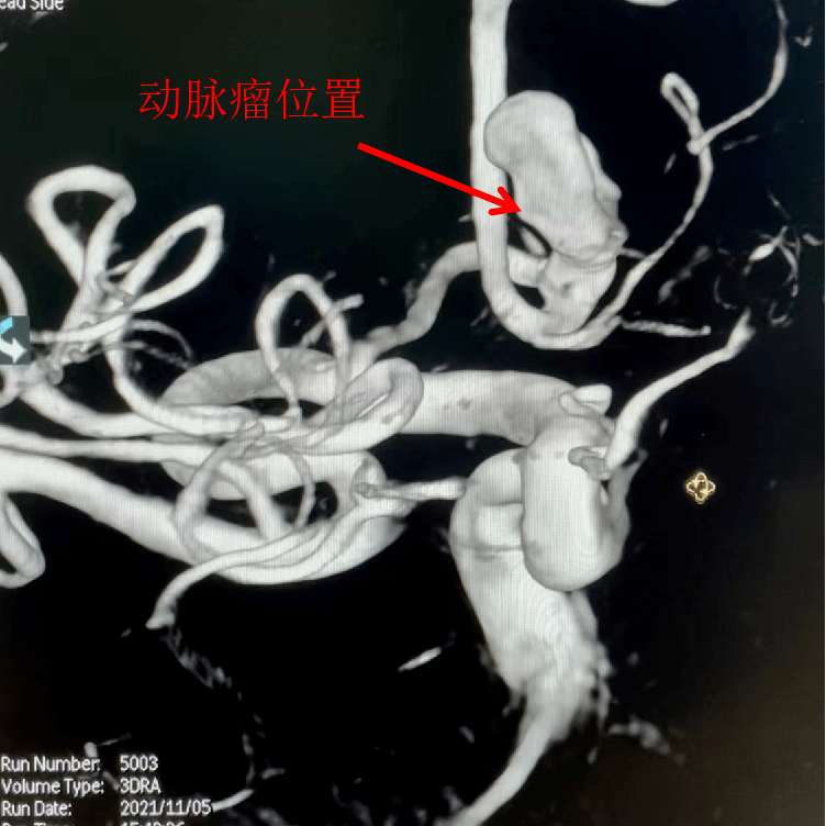 送无阻、顺必达—Phenom™ 27微导管在前循环远端血管中的应用_支架_Flex_血流