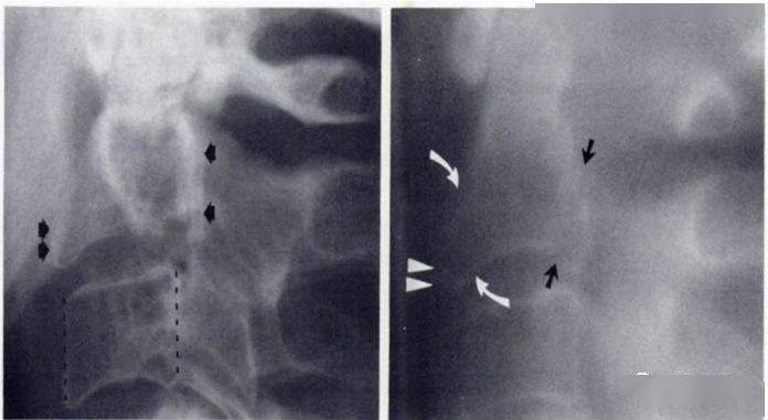 三十个脊柱影像征象，您都见过么_关节_sign_颈椎