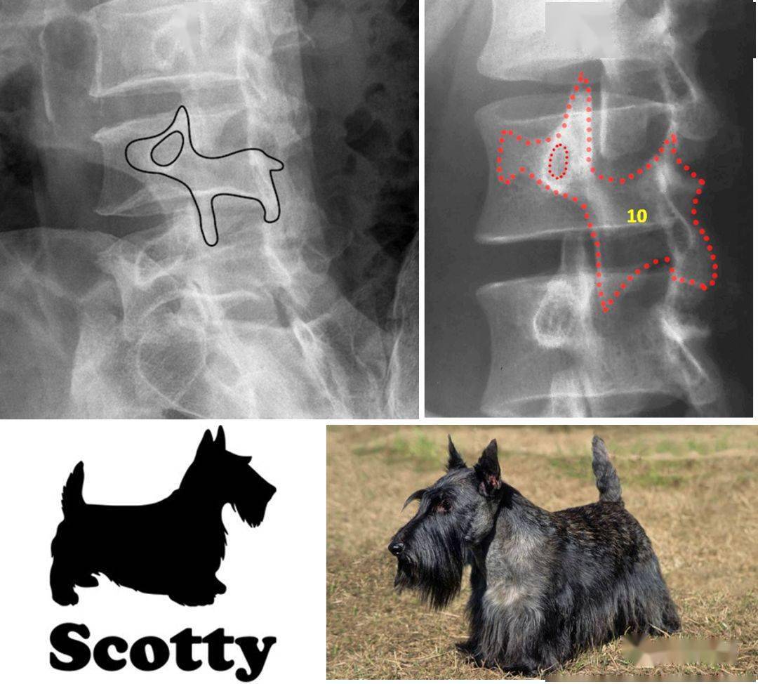 三十个脊柱影像征象，您都见过么_关节_sign_颈椎