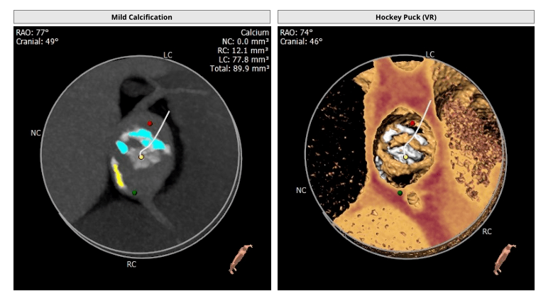 TAVR20年·重庆首例｜陆军军医大学大坪医院心血管内科团队顺利完成ECMO支持下TAVR手术_mmHg_患者_瓣膜