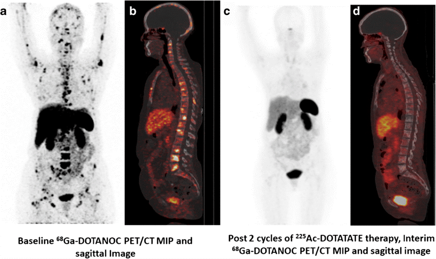 【专栏】北京肿瘤医院杨志教授 | 核素诊疗一体化_诊断_治疗_中国核学会