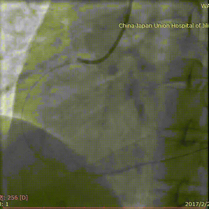STEMI溶栓•经典病例｜急性心梗冠脉高血栓负荷处理一例_支架_松原_患者
