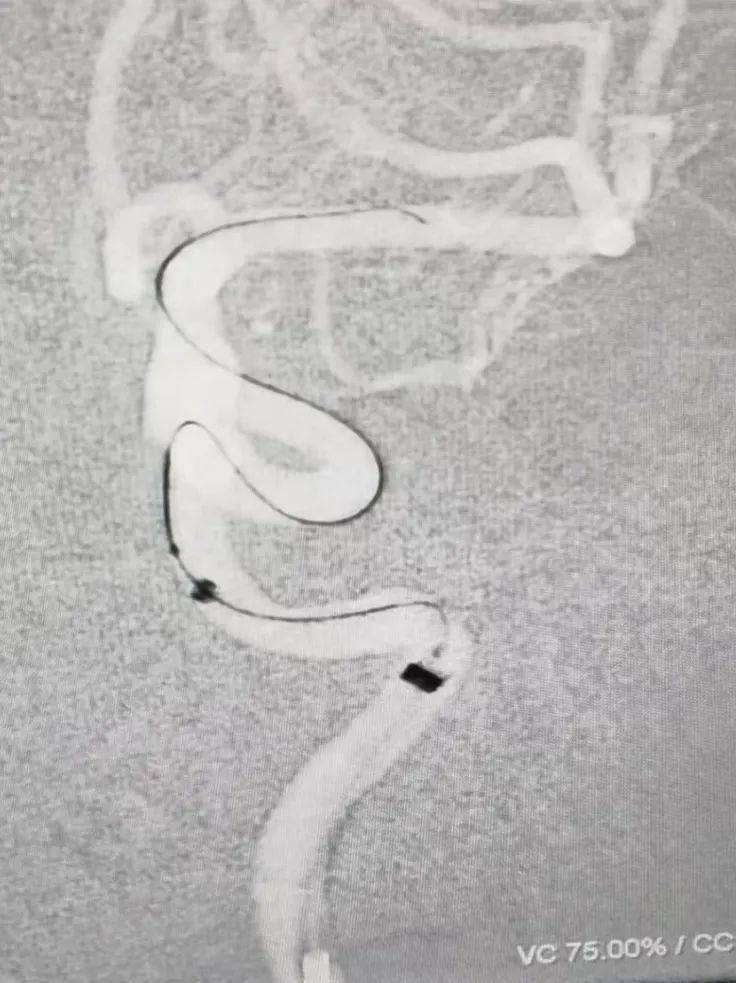 术说·第十七期丨Infinity长鞘助力Surpass Streamline血流导向密网支架治疗双侧颈内迂曲路径动脉瘤一例_手术_脑血管_基础