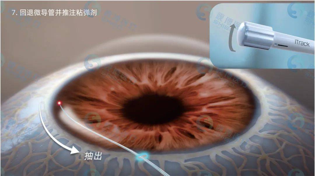 图解： iTrack 内路粘小管成形术（ABiC），一种微创高效的青光眼手术_切口_眼压_导管