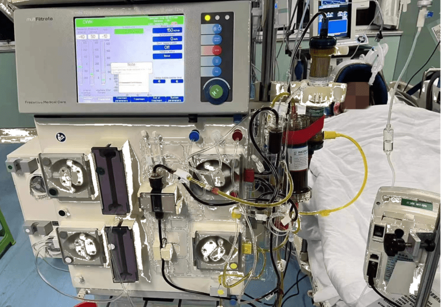 岚山区人民医院：DPMAS，这项技术为肝衰竭患者带来新生！_治疗_重症_血浆