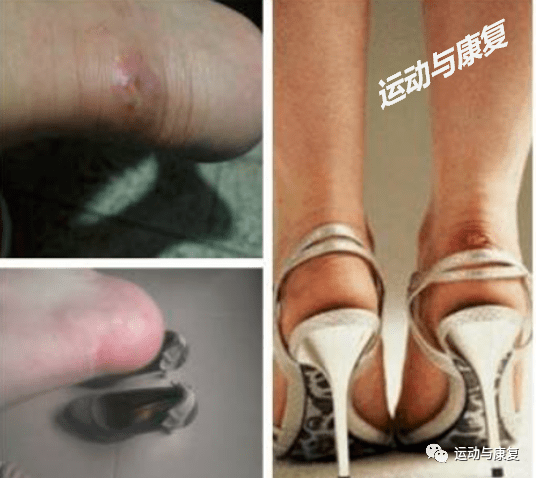 哈格伦德综合征（Haglund's Disease) – 跑者的恶梦_畸形_脚后跟_鞋子