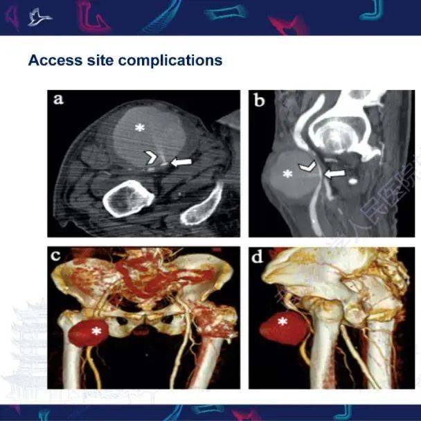 腹主动脉瘤EVAR术后并发症CT评估_影像_解剖图_全网