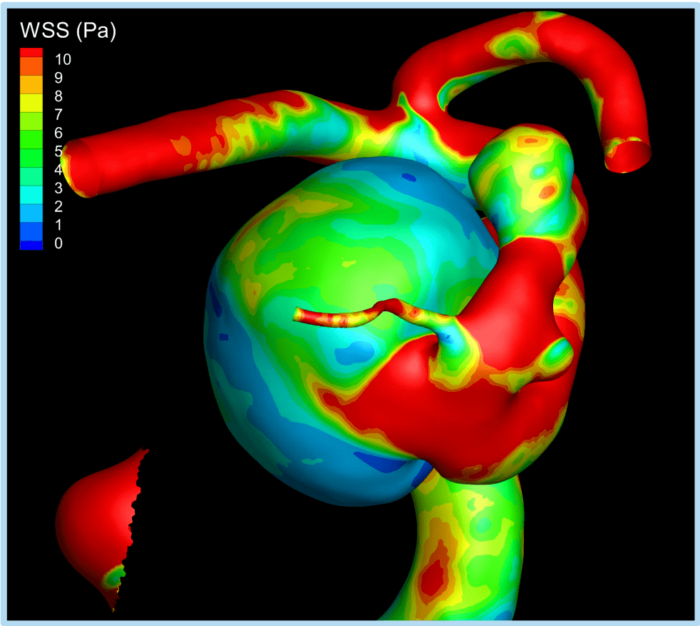 术说·第二十一期丨Surpass Streamline血流导向密网支架治疗颈内动脉多发动脉瘤初体验_中国医师协会_全国_导管