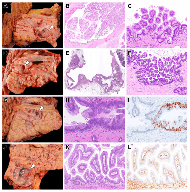 Gastroenterology | 新型NGS检测方法PancreaSeq可准确区分不同类型胰腺囊肿，敏感性和特异性更高_研究_恶性肿瘤_患者