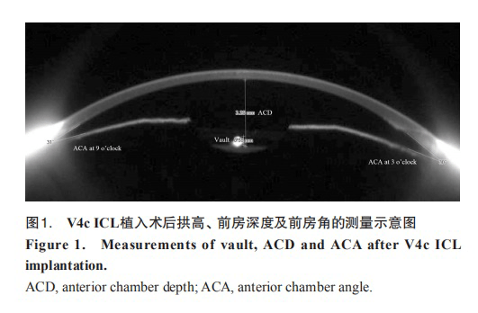 【ACD详细解析】一文读懂：前房深度_晶状体_屈光_mm