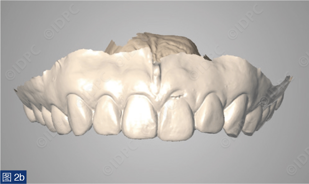 【精选案例】CAD/CAM愈合基台及美学区引导手术实现软组织轮廓保存：病例报告（美）_种植_牙龈
