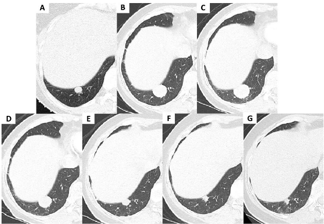 接种新冠疫苗后，肿瘤自发消退了？_体细胞_显示_反应