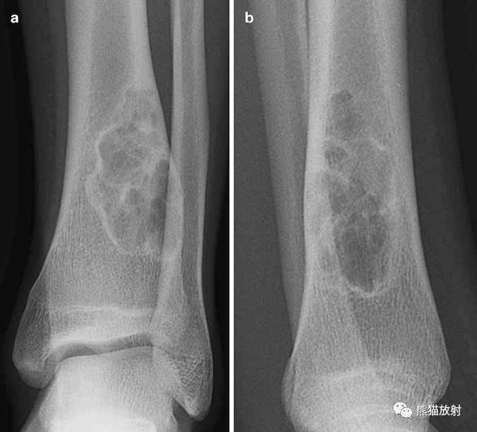 骨肿瘤病例丨非骨化性纤维瘤~_pain_病变_诊断