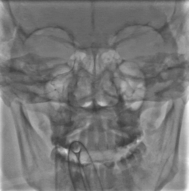 刘永康、程光森：Fluxcap球囊导引导管辅助颈内动脉闭塞开通_造影_cm_微导