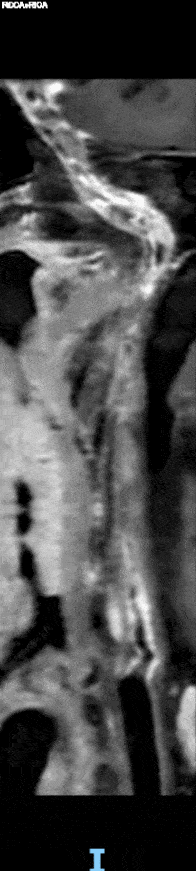 刘永康、程光森：Fluxcap球囊导引导管辅助颈内动脉闭塞开通_造影_cm_微导