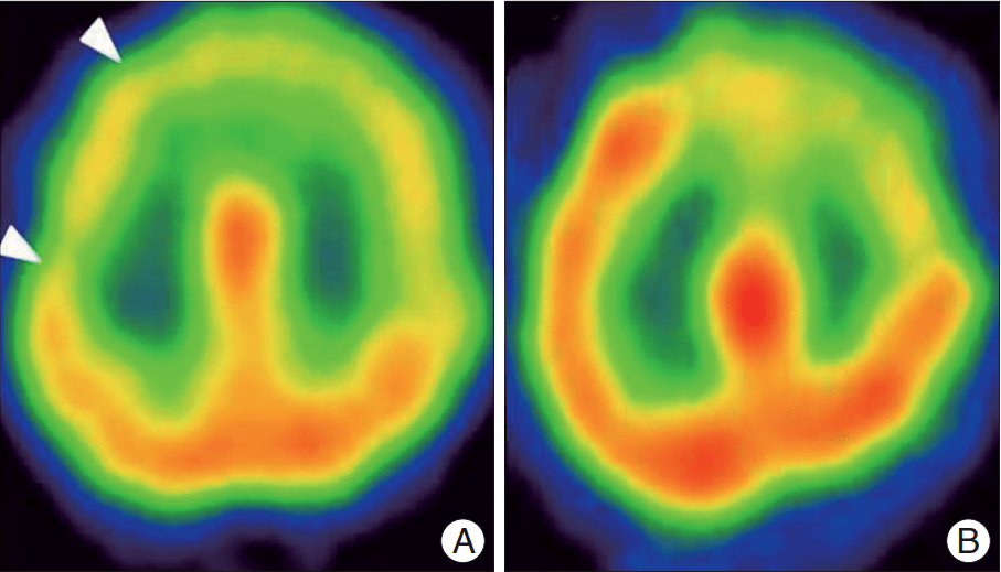 关于SPECT扫描那些事儿_检查_显示_放射性物质